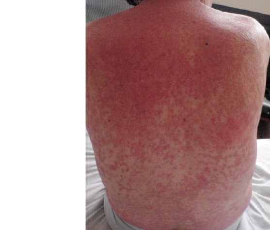 Pustulosis exantemática aguda generalizada relacionada al uso de ...