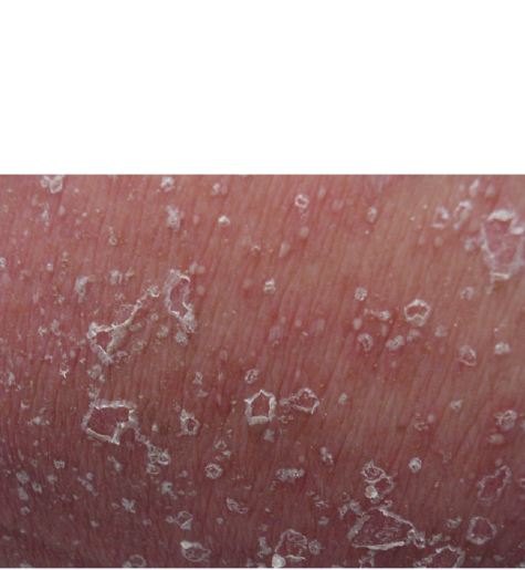 Pustulosis exantemática aguda generalizada relacionada al uso de ...