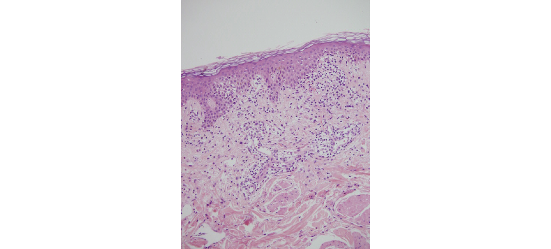 Acute Generalized Exanthematous Pustulosis Histology