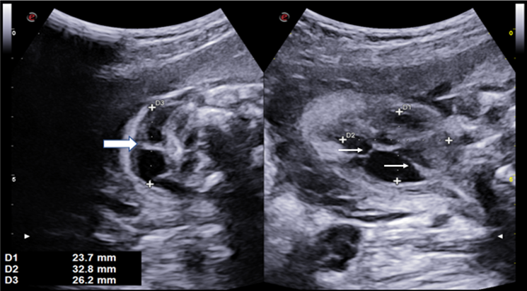 Figure 5 Ultrasound at 20 weeks of pregnancy showing septal cervical ...