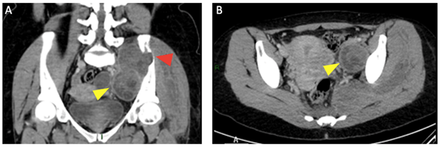 Figure 1 A) Enhanced CT scan of the abdomen and pelvis (coronal plane);