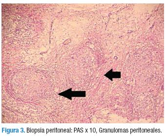View of Peritoneal tuberculosis with elevated levels of CA 125 ...