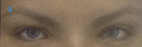 Síndrome de Waardenburg tipo 1 en gemelos monocigóticos y su familia ...