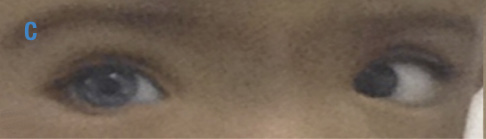 Síndrome de Waardenburg tipo 1 en gemelos monocigóticos y su familia ...