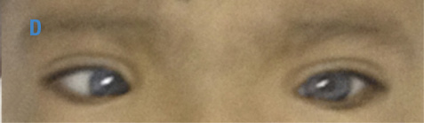 Síndrome de Waardenburg tipo 1 en gemelos monocigóticos y su familia ...