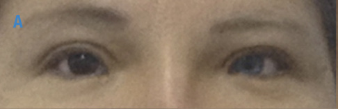 Síndrome de Waardenburg tipo 1 en gemelos monocigóticos y su familia ...